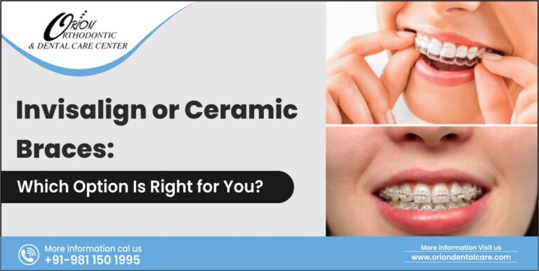 Invisalign or Ceramic Braces: Which Option Is Right for You?