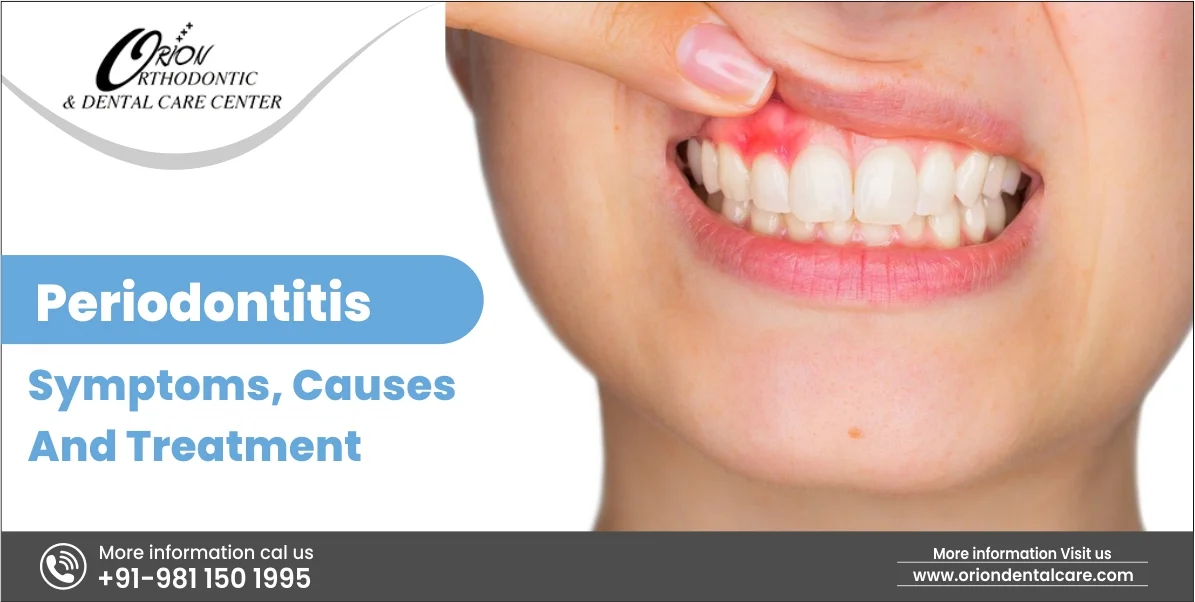 Periodontitis – Symptoms, Causes And Treatment - Orion Dental Care